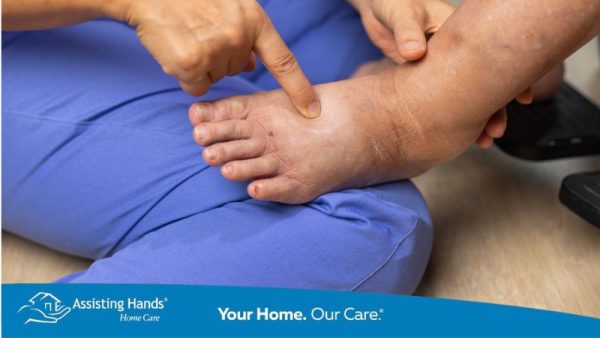 Edema in Elderly: Causes, Symptoms, and Home Care Tips